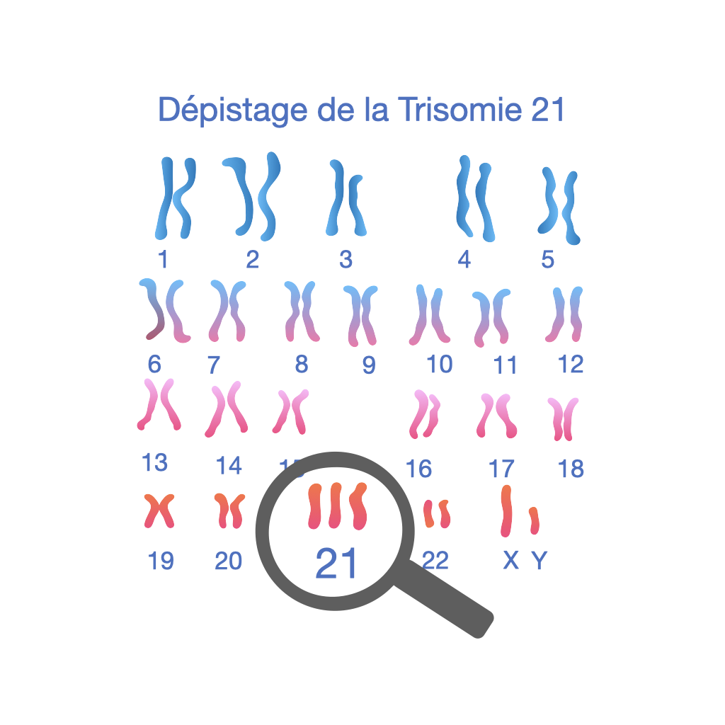 Le dépistage de la Trisomie 21